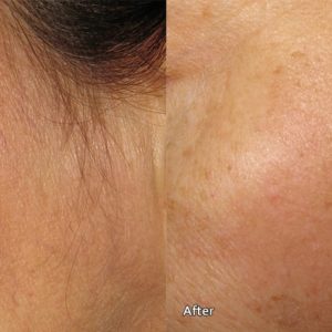 PicoWay and PicoWay Resolve | Radiance Skin Rejuvenation Centre