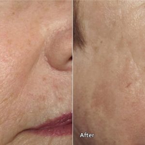 PicoWay and PicoWay Resolve | Radiance Skin Rejuvenation Centre